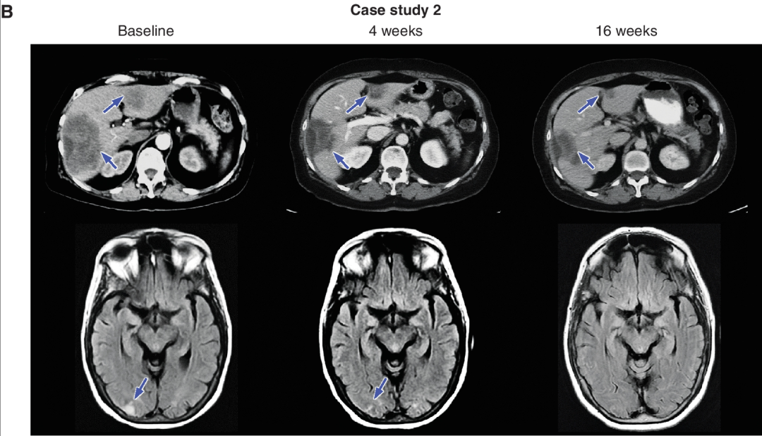 美国FDA授予新型ROS1靶向药NVL-520(Zidesamtinib)治疗转移性ROS1阳性非小细胞肺癌突破性疗法称号
